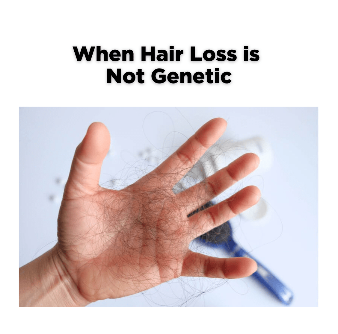 When Hair Loss is Not Genetic